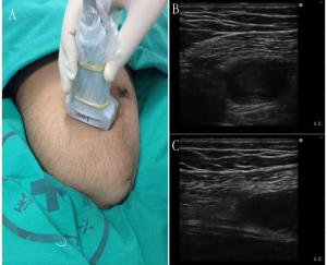 Ultrasound-guided alcohol neurolysis and radiofrequency ablation of pa ...