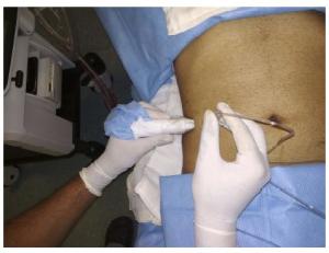 Anesthetic techniques: focus on transversus abdominis plane (TAP) bloc ...