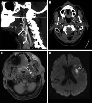 Spontaneous cervical artery dissection in patients aged over 70 years ...