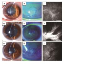 Association of fluorescein anterior corneal mosaic and corneal K-struc ...