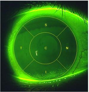 A novel scale for describing corneal staining | OPTH