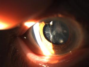 Monitoring and management of the patient with pseudoexfoliation syndro ...